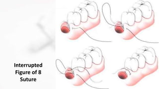 Dental Suturing: materials and techniques. | PPTX