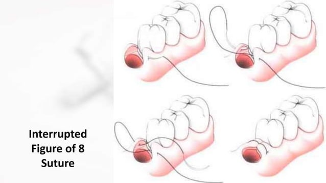 Dental Suturing: materials and techniques. | PPTX | First Aid | Injuries
