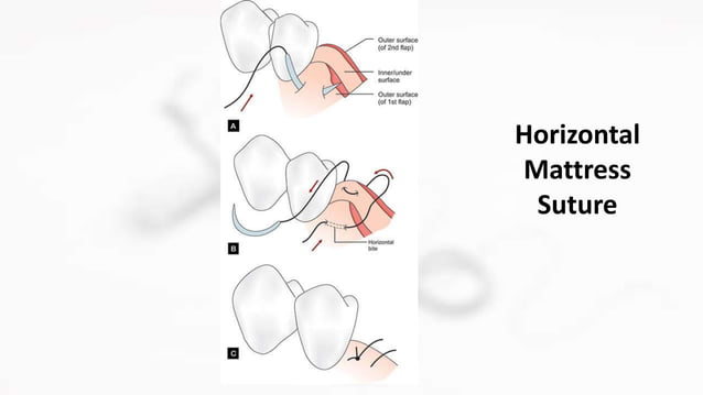 Dental Suturing: materials and techniques. | PPTX | First Aid | Injuries