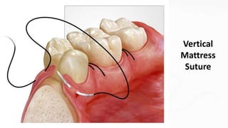 Dental Suturing: materials and techniques. | PPTX