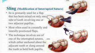 Dental Suturing: materials and techniques. | PPTX