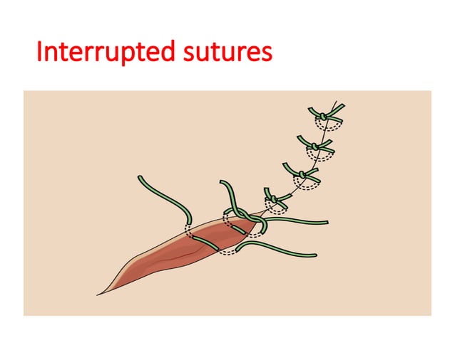SUTURE AND SUTURING TECHNIQUES IN SURGERY | PPTX | First Aid | Injuries