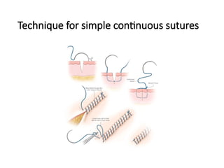 SUTURE AND SUTURING TECHNIQUES IN SURGERY | PPTX