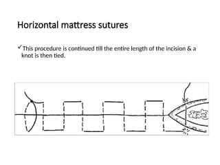 SUTURE AND SUTURING TECHNIQUES IN SURGERY | PPTX