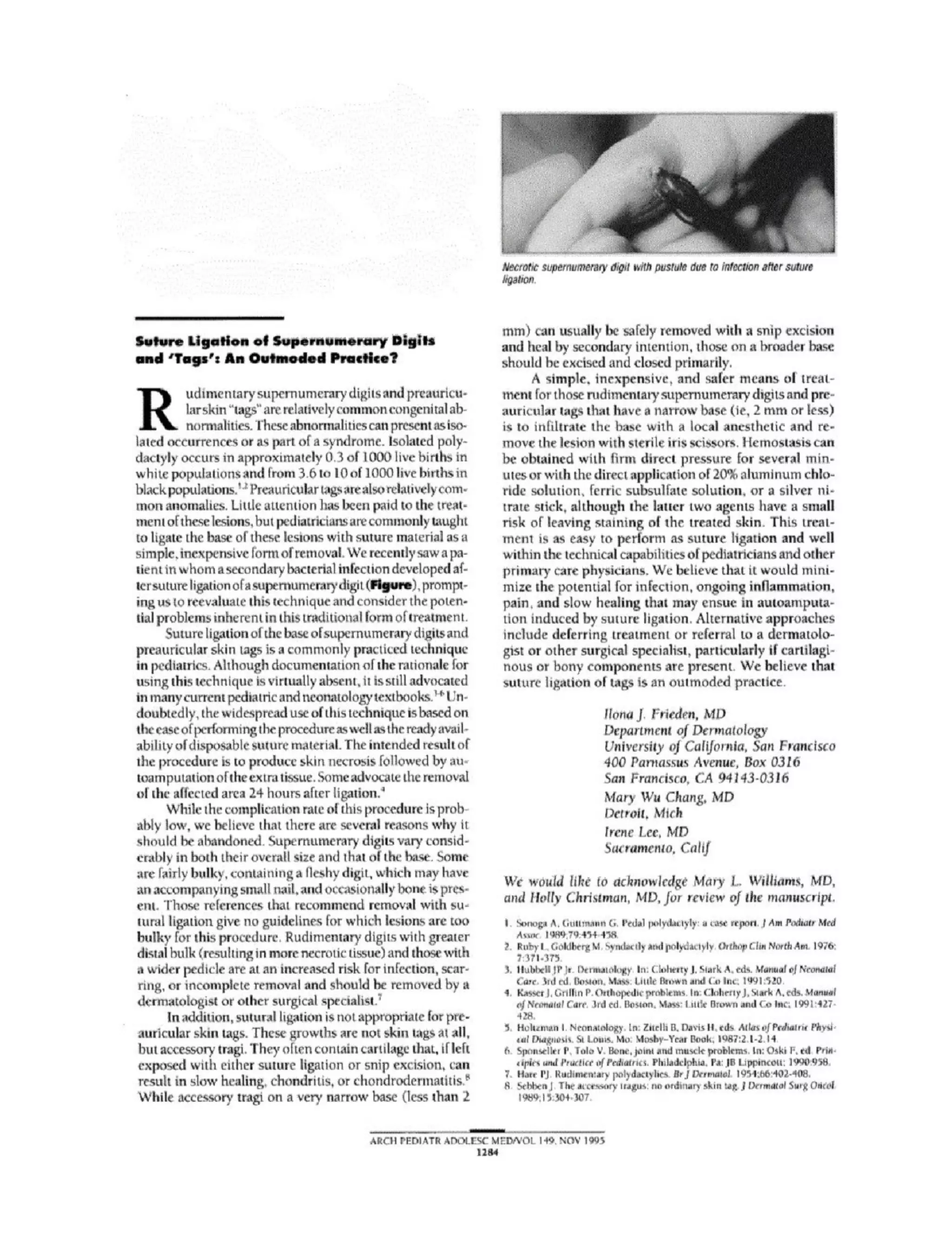 Suture ligation of supernumerary digits and tags :An outmoded practice ...