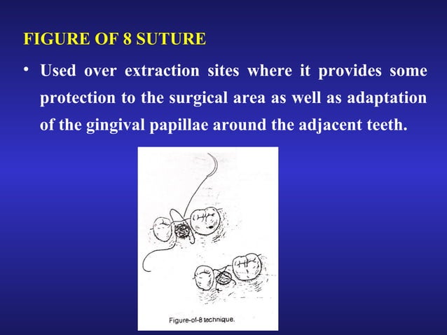 Suture material | PPT | First Aid | Injuries