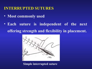 Interrupted Sutures
