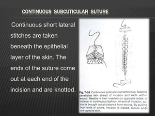Suture material & suturing technique | PPTX