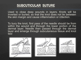 Buried Knot Suture