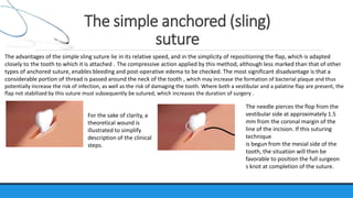 Suture material & suturing technique | PPTX