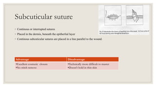 Suture, needle and knots | PPTX