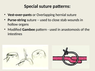 suture patterns , types , uses and tools | PPTX