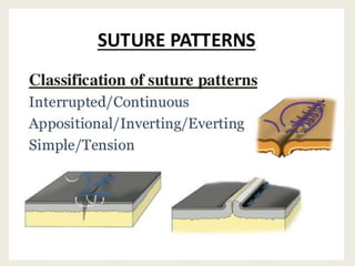 suture patterns , types , uses and tools | PPTX