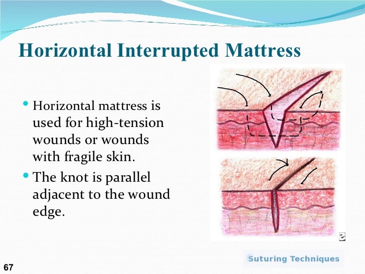 Suture presentation by Dr. Nabeel ur Rehman and Dr. Suneel Maghnani