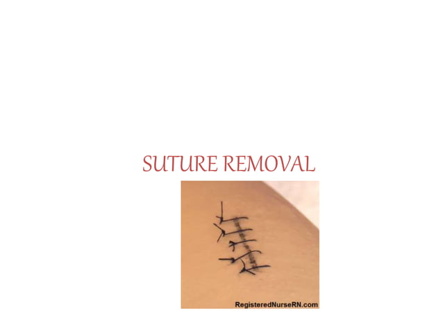 suture removal ppt.pptx medical surgical | PPTX