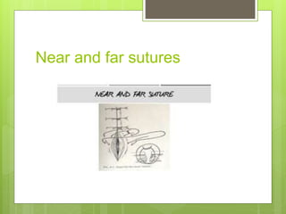 Sutures | PPTX