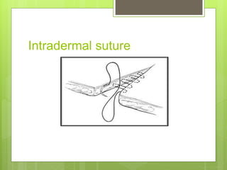 Sutures | PPTX