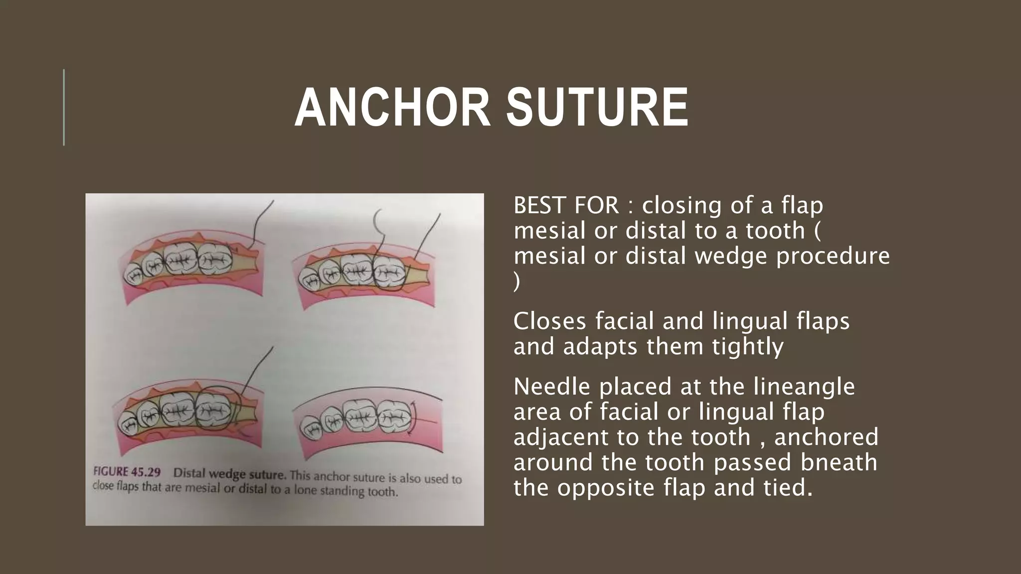 Periodontal Sutures | PPTX