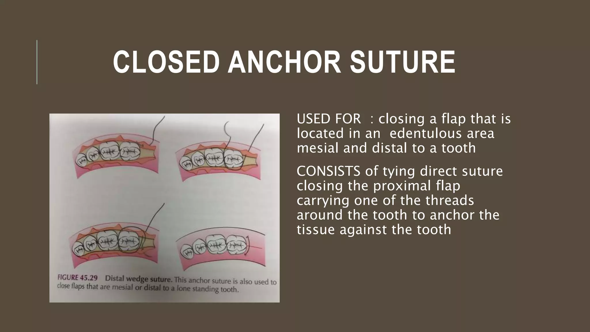 Periodontal Sutures | PPTX