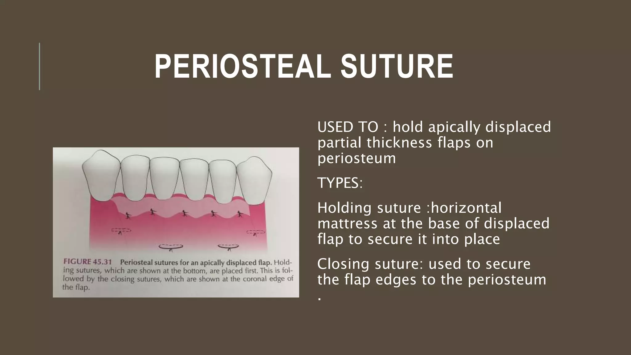 Periodontal Sutures | PPTX