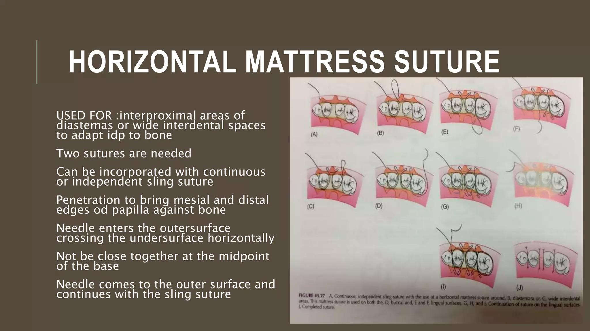 Periodontal Sutures | PPTX