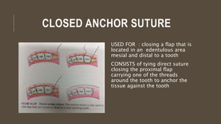 Periodontal Sutures | PPTX