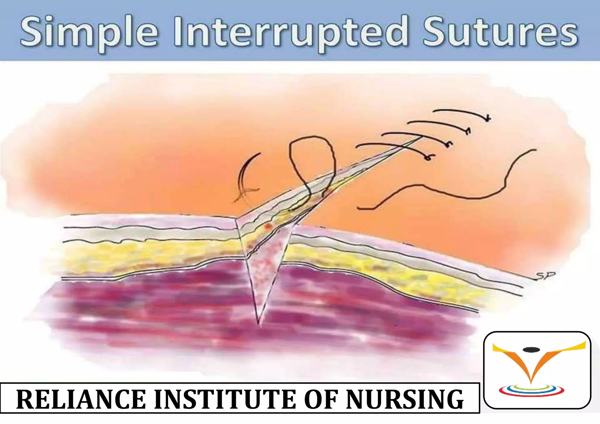 Sutures Sutures | PPT