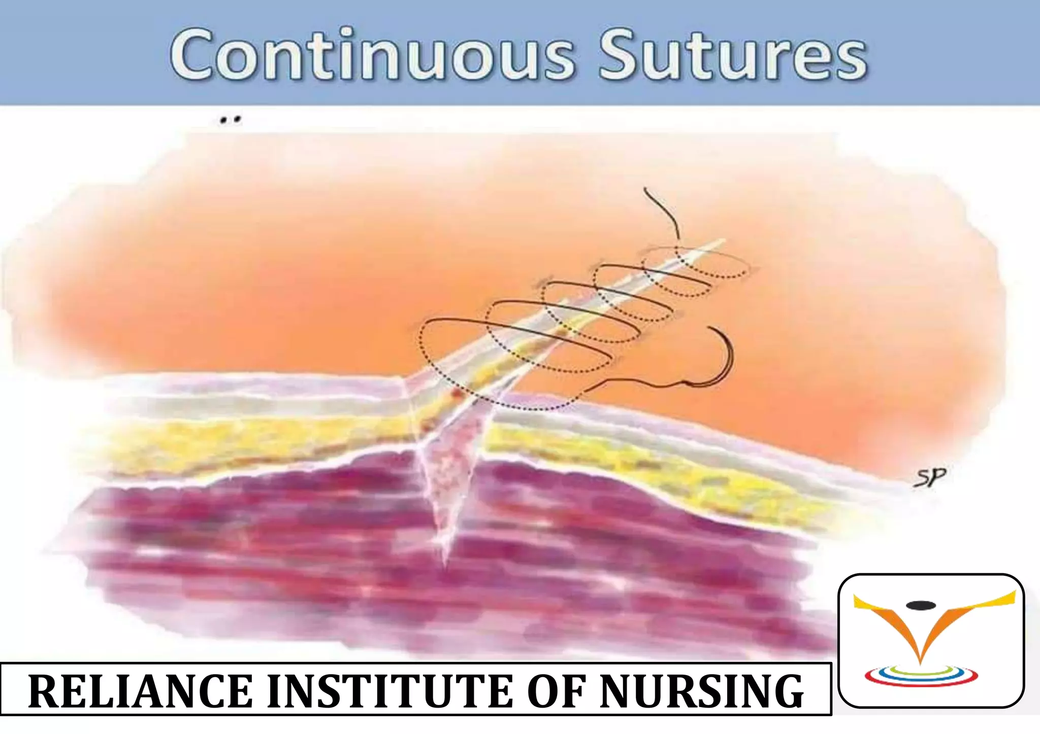 Sutures Sutures | PPT