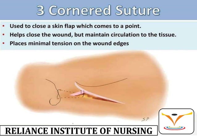 Sutures Sutures | PPT
