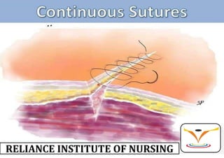 Sutures Sutures | PPTX