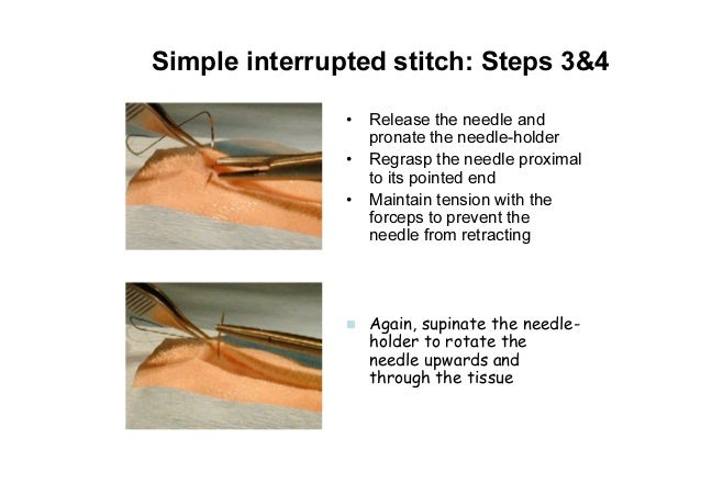 Sutures and suturing