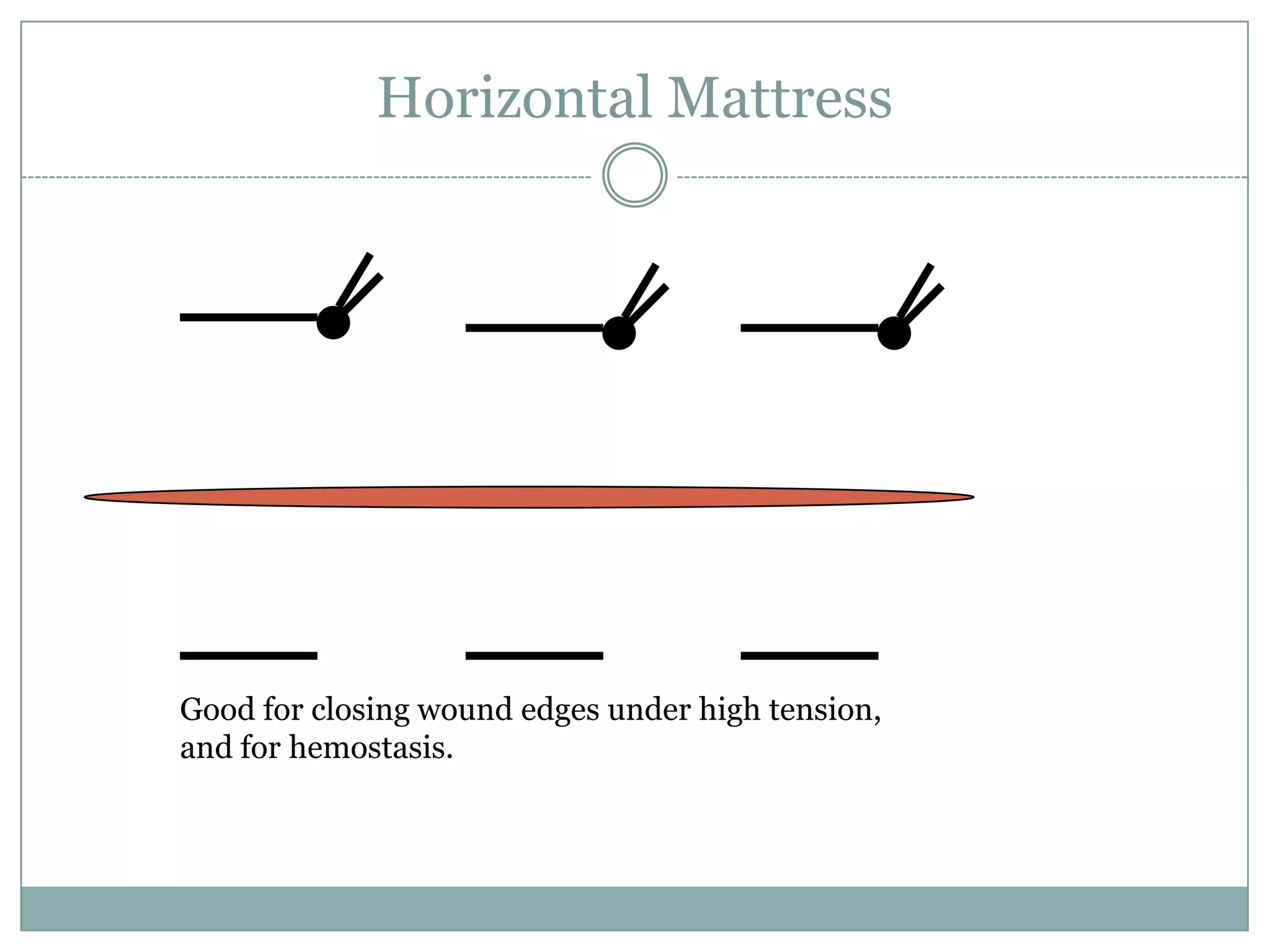 Sutures and suturing patterns in surgery & modern innovations | PPTX