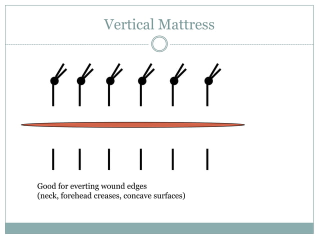Sutures and suturing patterns in surgery & modern innovations | PPT