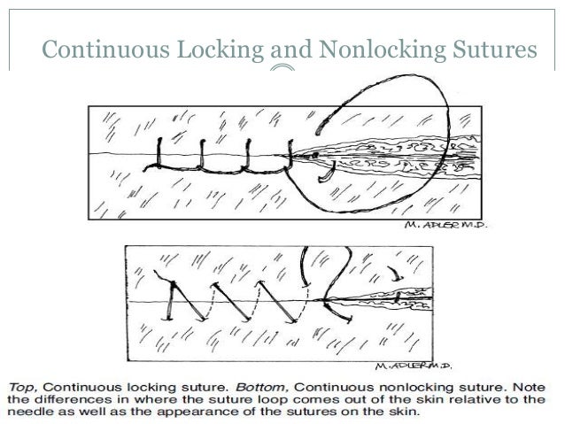 Sutures and suturing patterns in surgery & modern innovations