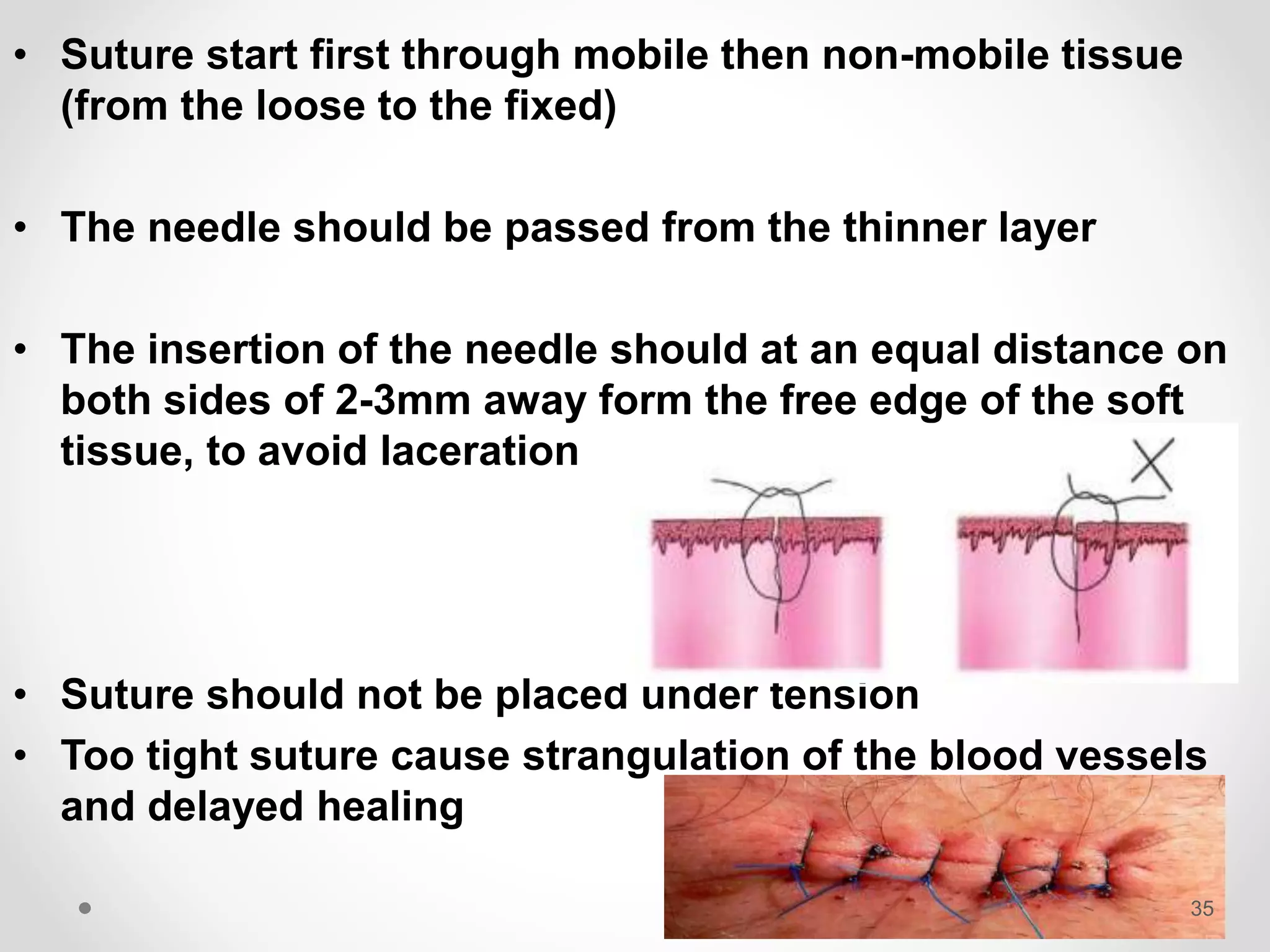 Sutures emad | PPT