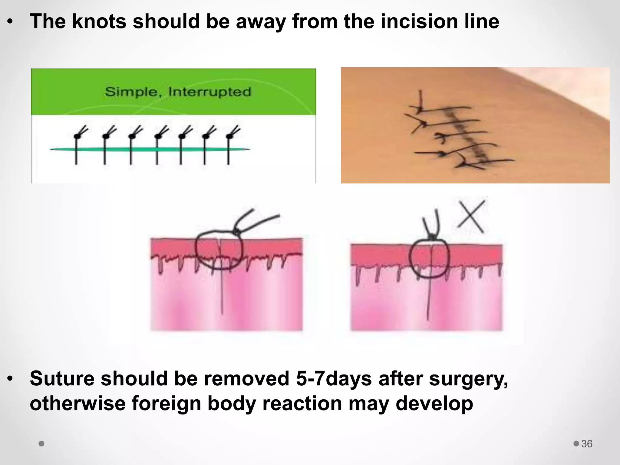 Sutures emad | PPT