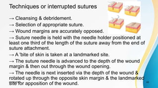 SUTURES MATERIALS & SUTURING TECHNIQUES.pptx