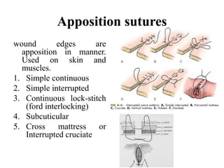 Sutures, sutures materials and suturing patterns | PPT