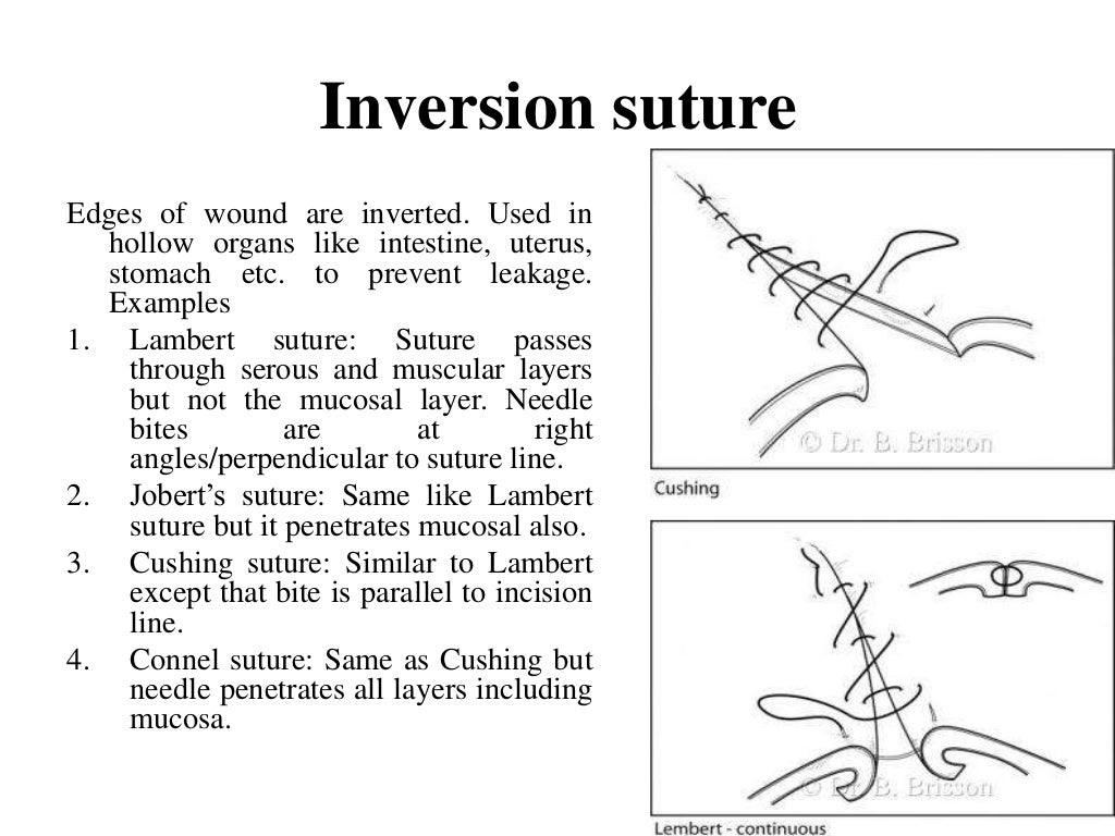 Sutures, sutures materials and suturing patterns