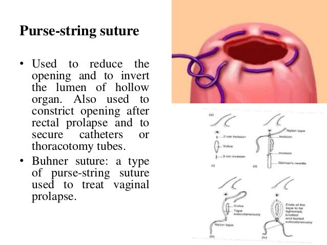 Sutures, sutures materials and suturing patterns