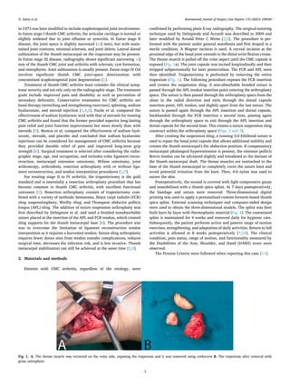 Suture Suspension Sling Arthroplasty for Thumb CMC Joint Arthritis ...