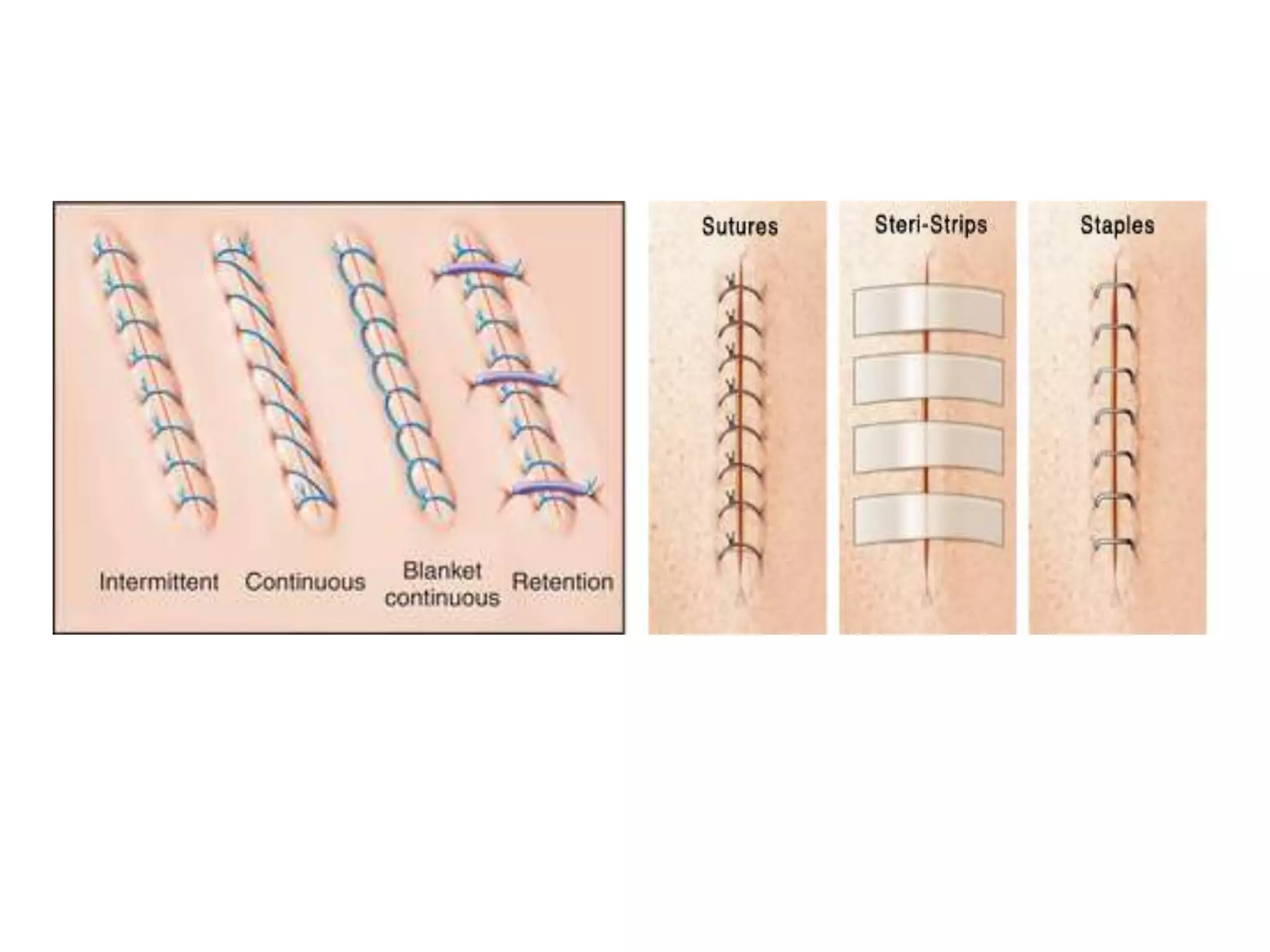 Suturing | PPTX