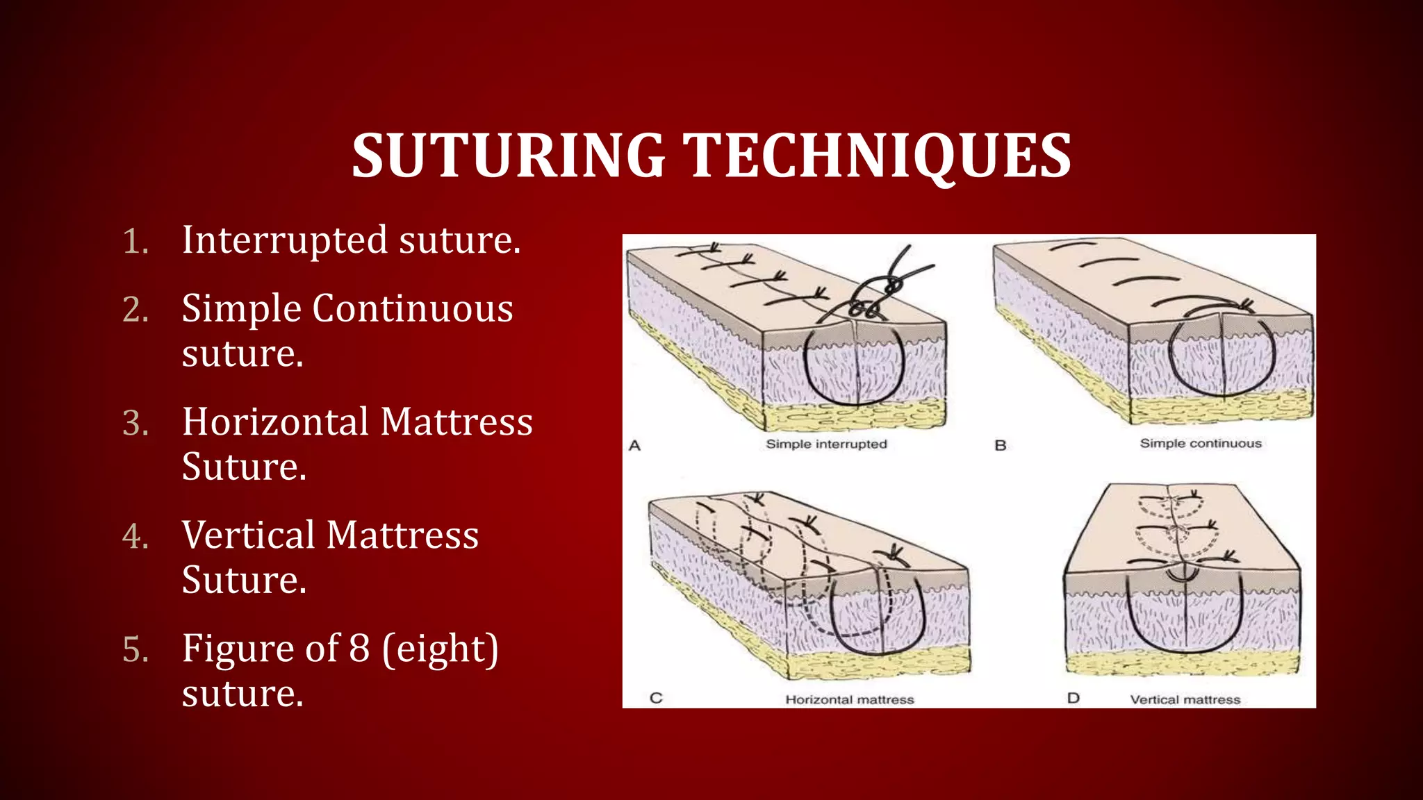 Suturing and its technique | PPTX