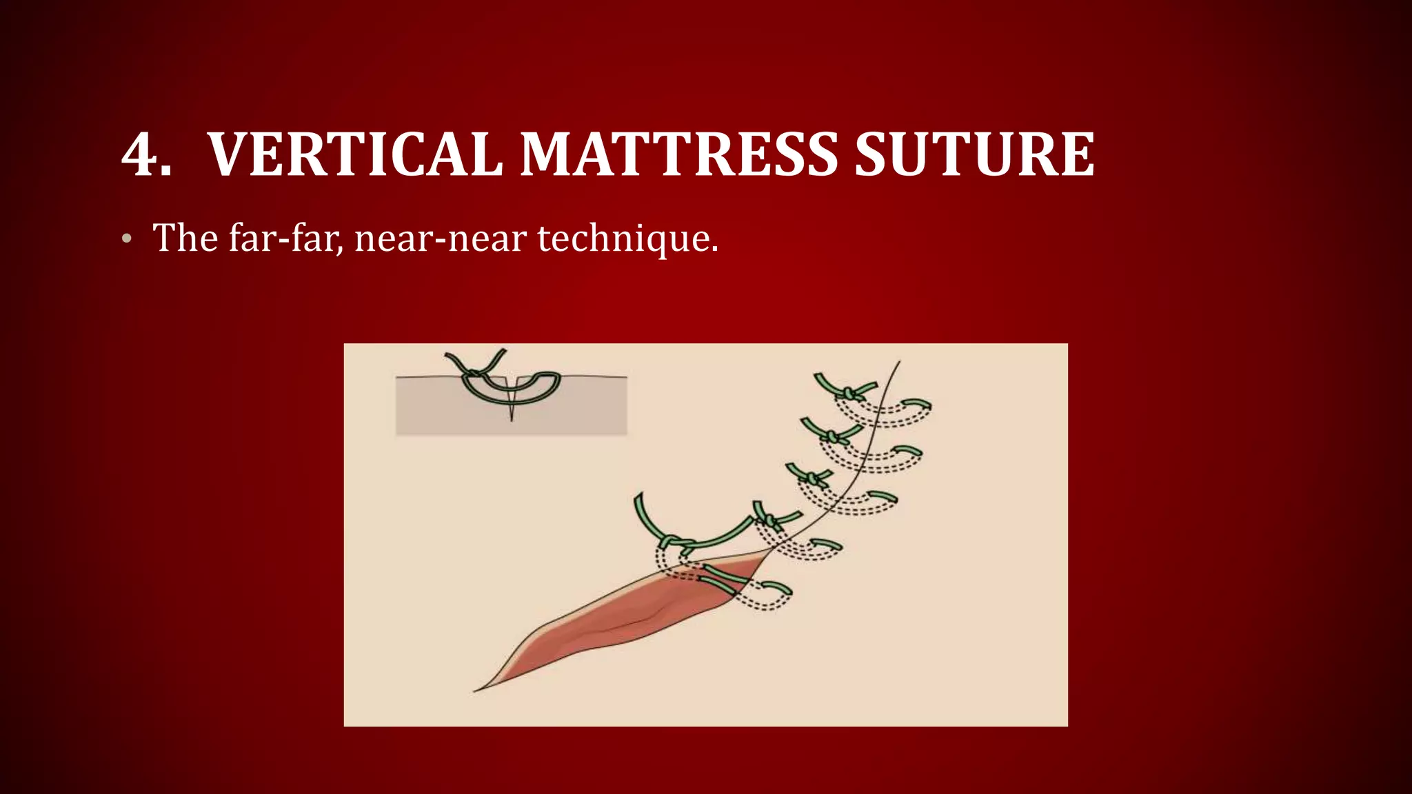 Suturing and its technique | PPTX