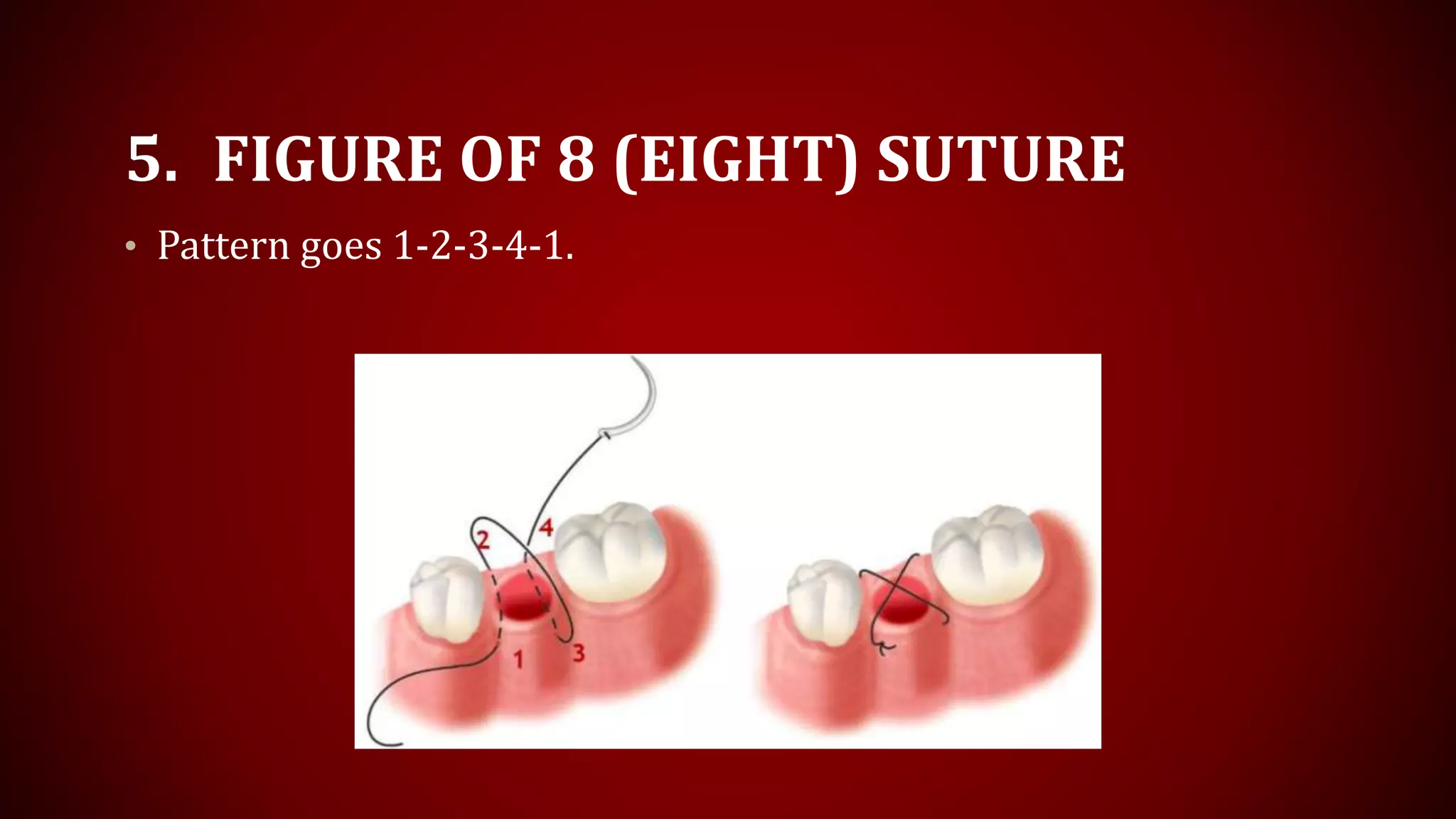 Suturing and its technique | PPTX