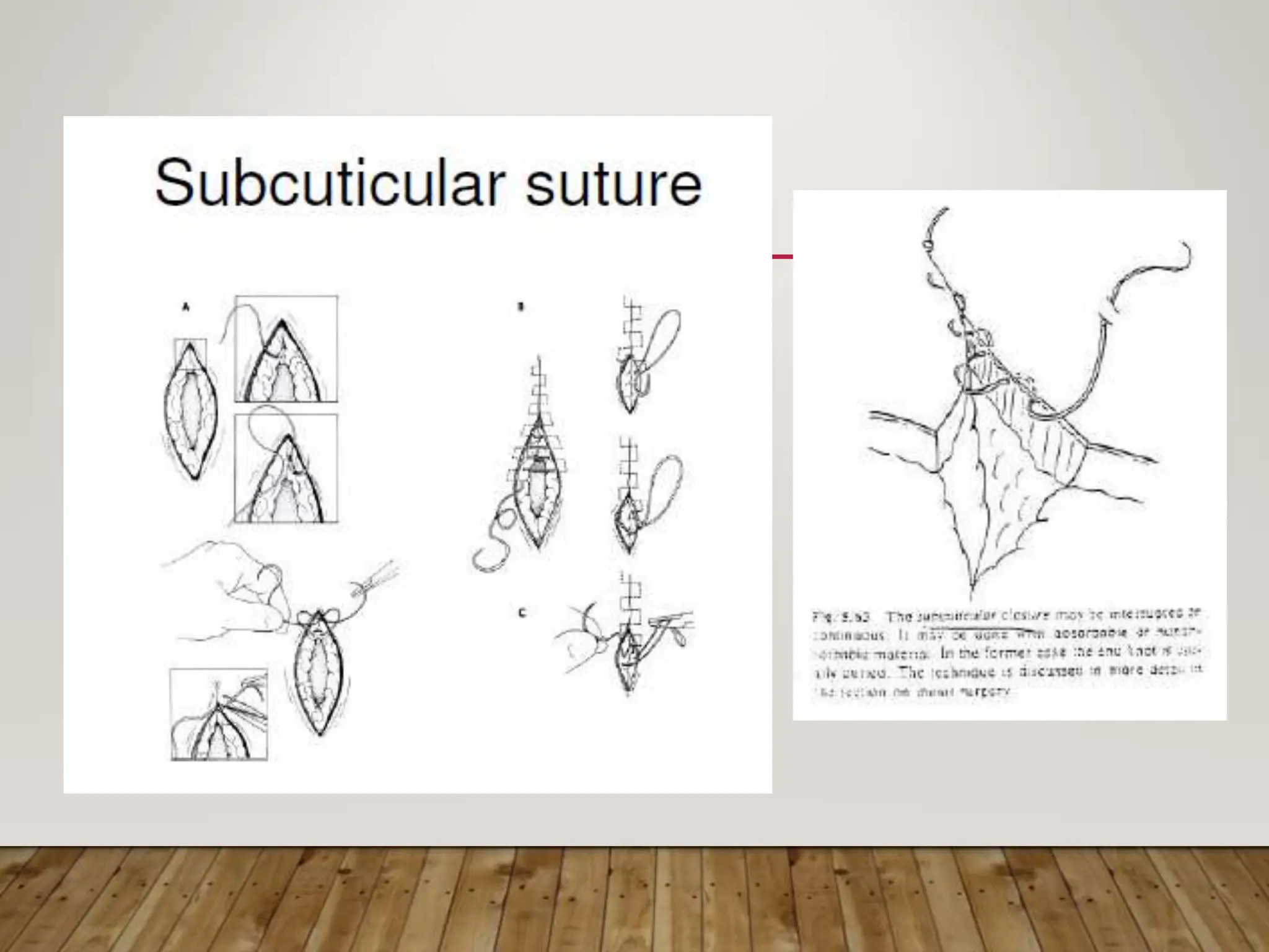 SUTURING AND SUTURE MATERIALS.lecture.pptx