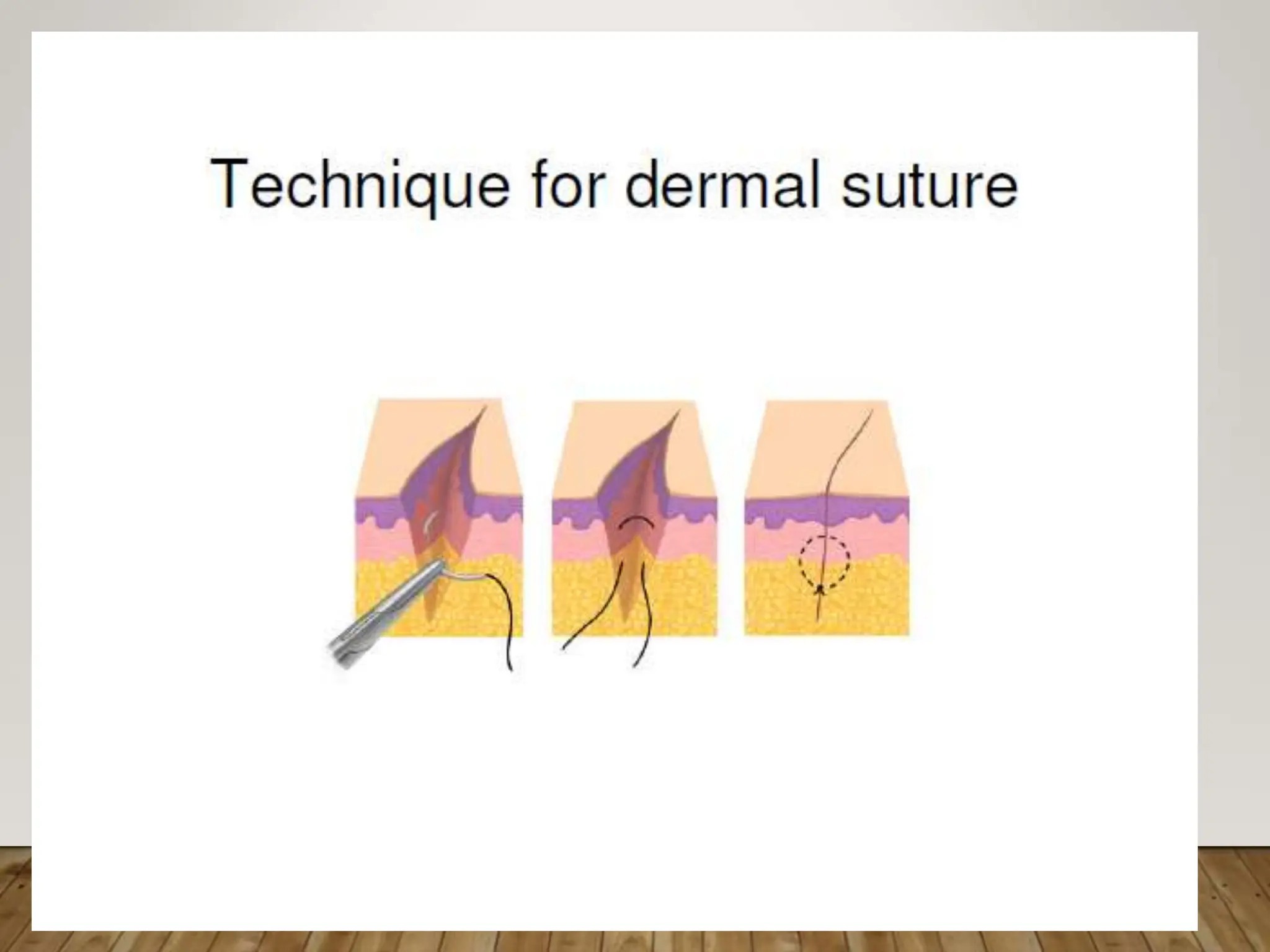 SUTURING AND SUTURE MATERIALS.lecture.pptx