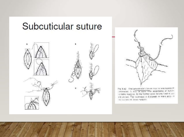 SUTURING AND SUTURE MATERIALS.lecture.pptx