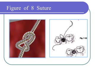 sutures and suturing technique | PPTX