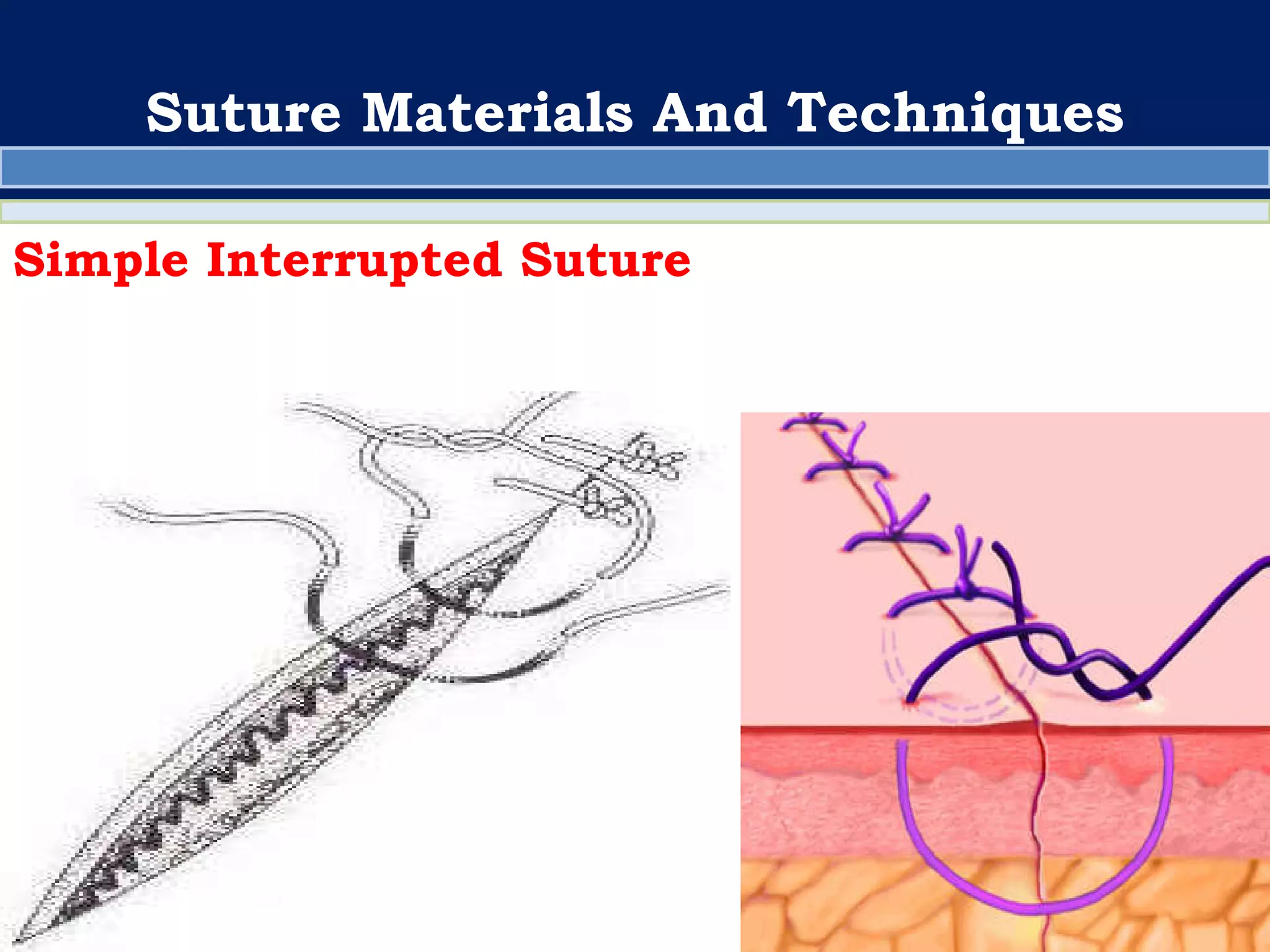 Suturing technique | PDF